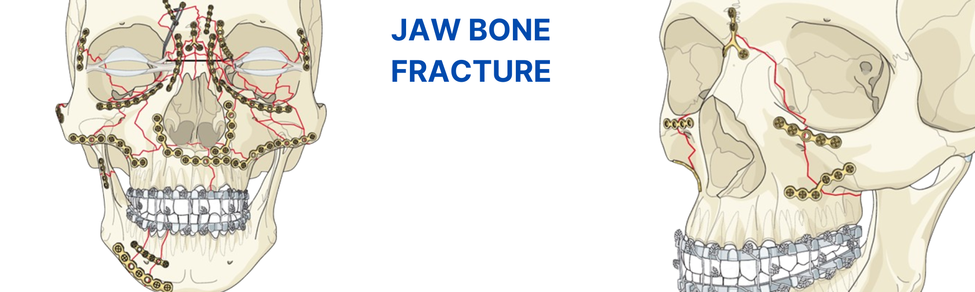 Expert Jaw Bone Fracture Surgery for a Stronger, Healthier Smile